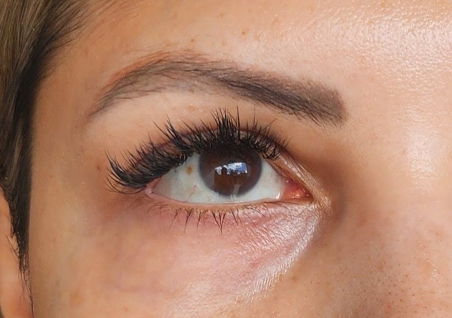 PRP Treatment for Undereye Rejuvenation