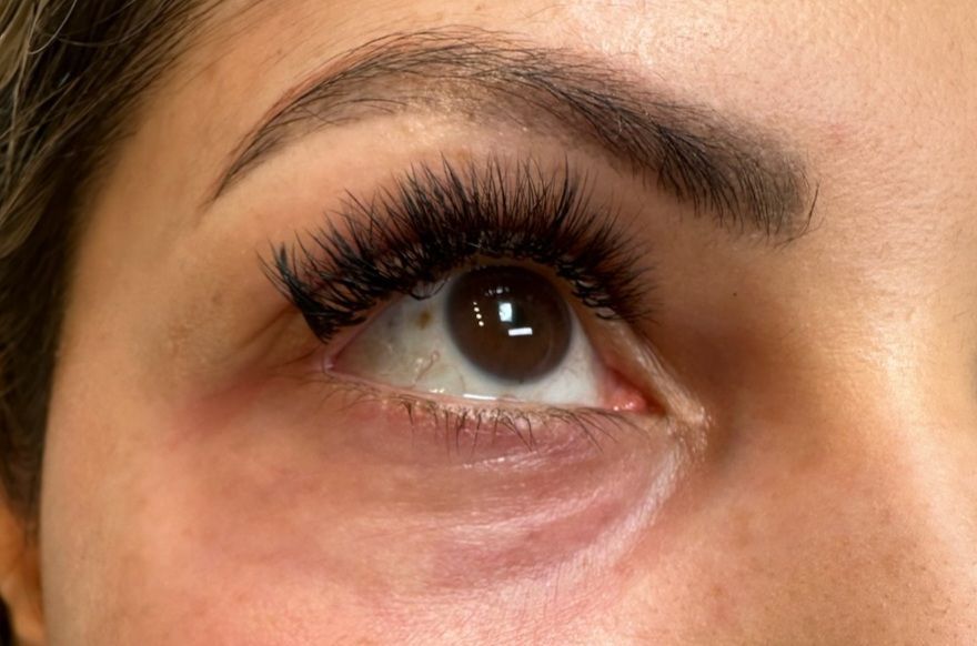 PRP Treatment for Undereye Rejuvenation